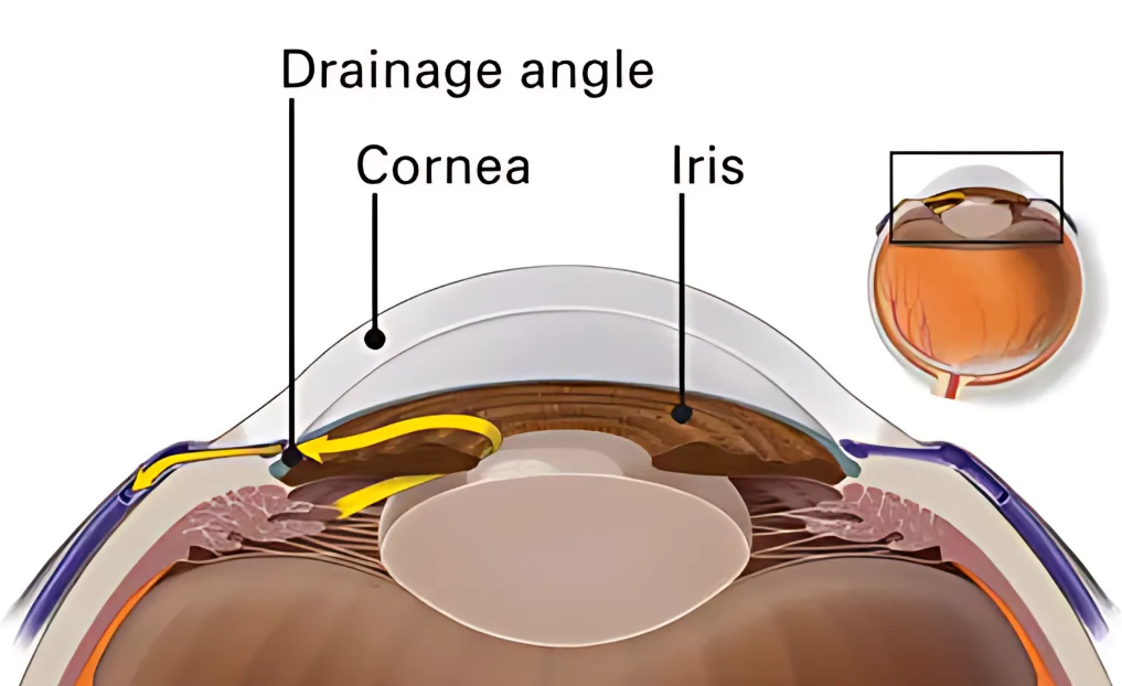 Understanding Different Types of Glaucoma | Glaucoma Australia